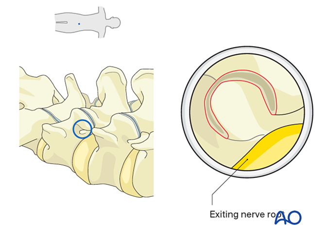 Transforaminal endoscopic lumbar discectomy (TELD) for Lumbar disc ...