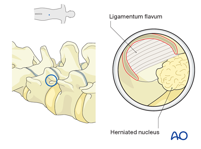 Transforaminal endoscopic lumbar discectomy (TELD) for Lumbar disc ...