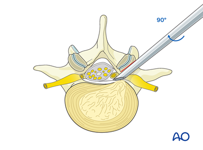 Transforaminal endoscopic lumbar discectomy (TELD) for Lumbar disc ...