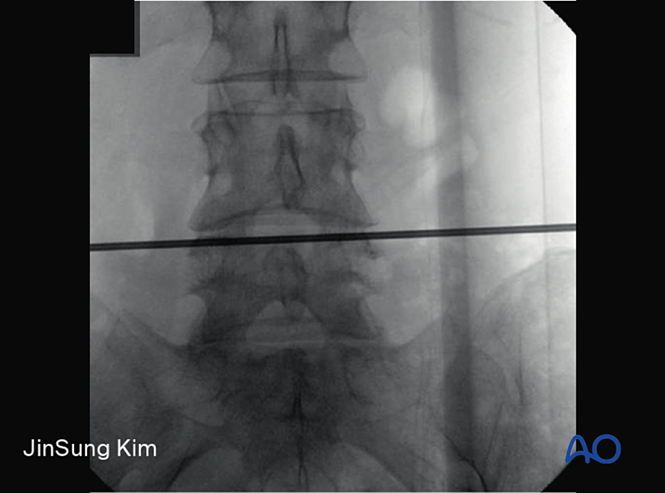 Transforaminal Endoscopic Lumbar Discectomy Teld For Lumbar Disc