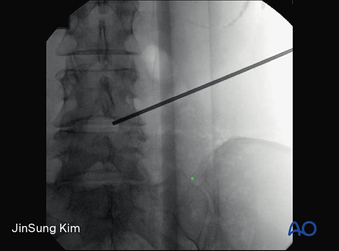 Transforaminal endoscopic lumbar discectomy (TELD) for Lumbar disc ...