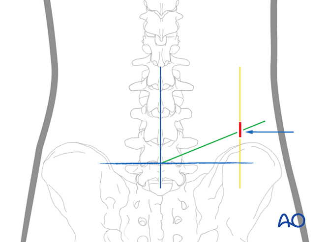 Transforaminal endoscopic lumbar discectomy (TELD) for Lumbar disc ...