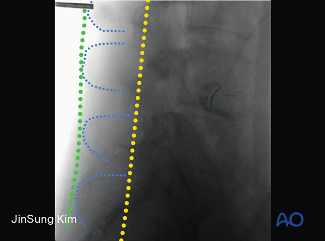 Extraforaminal Endoscopic Lumbar Discectomy Eeld For Lumbar Disc Herniation Foraminal And