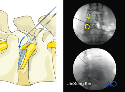 Transforaminal endoscopic lumbar discectomy (TELD) for Lumbar disc ...