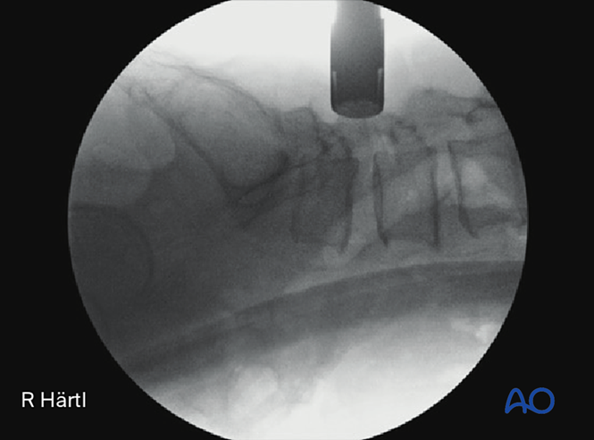 MISS Transforaminal lumbar interbody fusion (TLIF) for Lumbar spinal ...