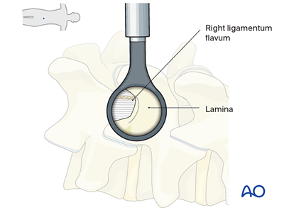 Interlaminar microscopic tubular lumbar discectomy (IMTLD) for Lumbar ...