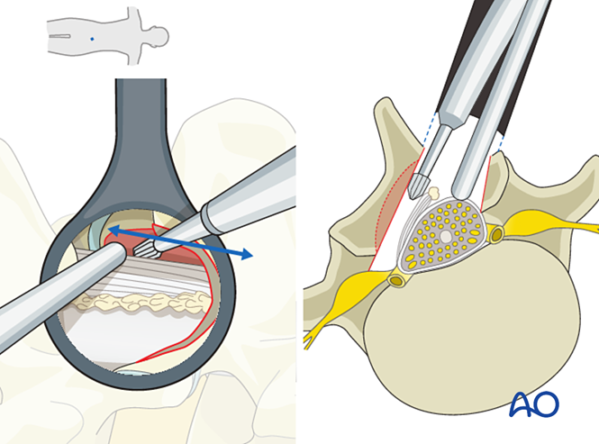 MISS Transforaminal lumbar interbody fusion (TLIF) for Degenerative ...