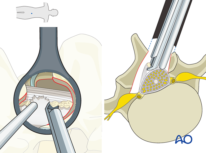 Microscopic tubular unilateral laminotomy for bilateral decompression ...