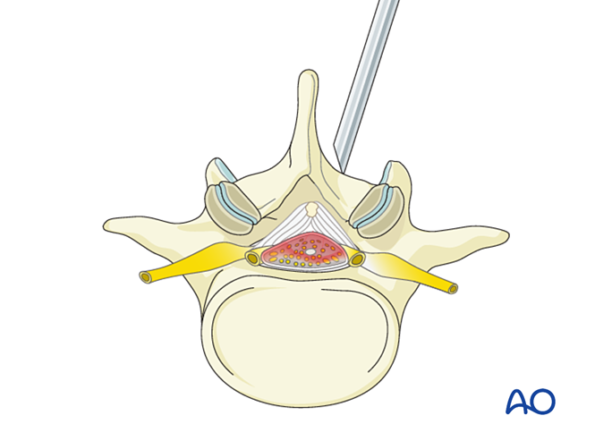 Lumbar endoscopic unilateral laminotomy for bilateral decompression (LE ...