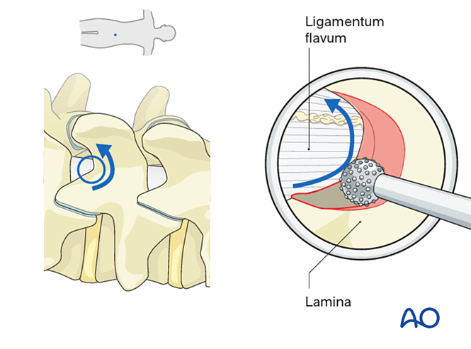 Lumbar endoscopic unilateral laminotomy for bilateral decompression (LE ...