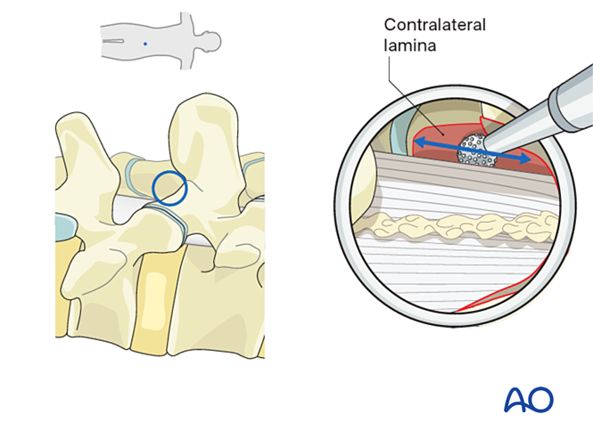 Lumbar endoscopic unilateral laminotomy for bilateral decompression (LE ...