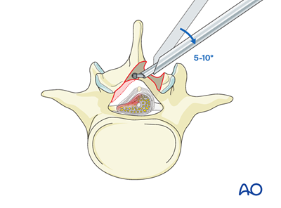 Lumbar endoscopic unilateral laminotomy for bilateral decompression (LE ...