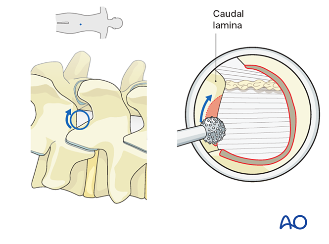 Lumbar endoscopic unilateral laminotomy for bilateral decompression (LE ...