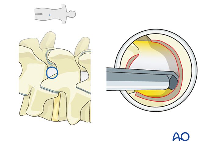 Lumbar endoscopic unilateral laminotomy for bilateral decompression (LE ...