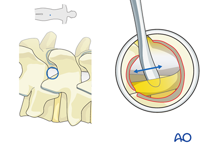 Lumbar endoscopic unilateral laminotomy for bilateral decompression (LE ...