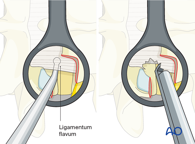 MISS Transforaminal lumbar interbody fusion (TLIF) for Degenerative ...