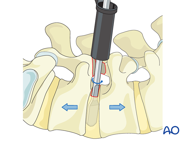 MISS Transforaminal lumbar interbody fusion (TLIF) for Lumbar spinal ...