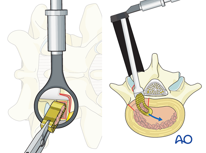 MISS Transforaminal lumbar interbody fusion (TLIF) for Lumbar spinal ...