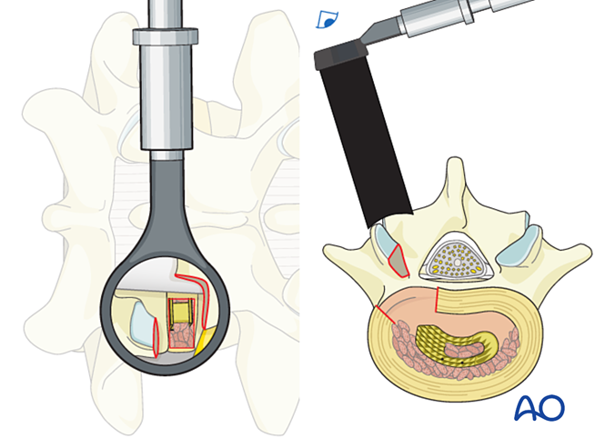 MISS Transforaminal lumbar interbody fusion (TLIF) for Degenerative ...
