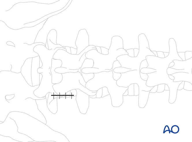 MISS Transforaminal lumbar interbody fusion (TLIF) for Degenerative ...