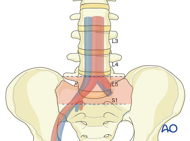 Anterior lumbar interbody fusion (ALIF) for Lumbar spinal stenosis
