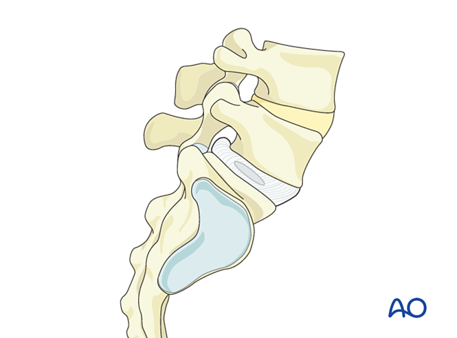 Anterior lumbar interbody fusion (ALIF) for Degenerative spondylolisthesis