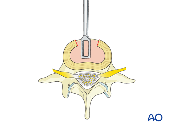 Anterior lumbar interbody fusion (ALIF) for Degenerative spondylolisthesis