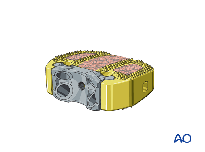Anterior lumbar interbody fusion (ALIF) for Lumbar spinal stenosis