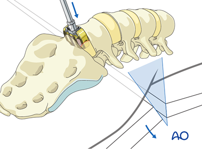 Anterior lumbar interbody fusion (ALIF) for Lumbar spinal stenosis