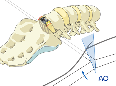 Anterior lumbar interbody fusion (ALIF) for Degenerative spondylolisthesis