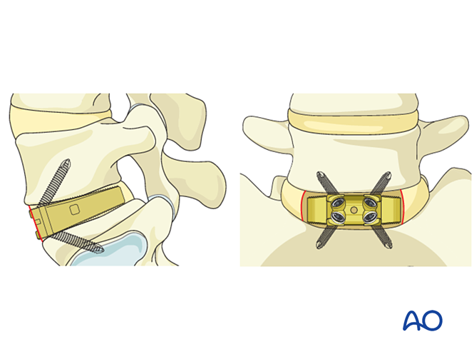 Anterior lumbar interbody fusion (ALIF) for Degenerative spondylolisthesis