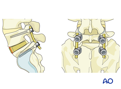 Anterior lumbar interbody fusion (ALIF) for Degenerative spondylolisthesis