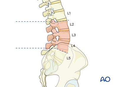 Lateral lumbar interbody fusion (LLIF) for Degenerative spondylolisthesis