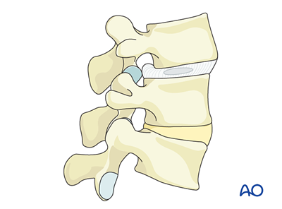 Lateral lumbar interbody fusion (LLIF) for Degenerative spondylolisthesis
