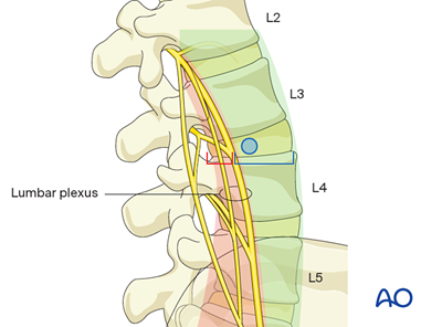 Lateral lumbar interbody fusion (LLIF) for Degenerative spondylolisthesis