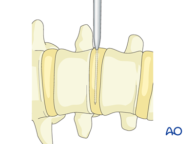 Lateral lumbar interbody fusion (LLIF) for Degenerative spondylolisthesis