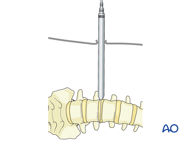 Lateral lumbar interbody fusion (LLIF) for Degenerative spondylolisthesis