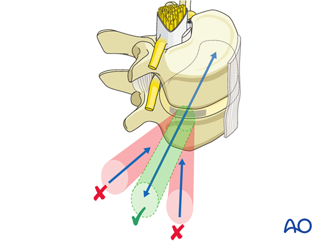 Lateral lumbar interbody fusion (LLIF) for Degenerative spondylolisthesis