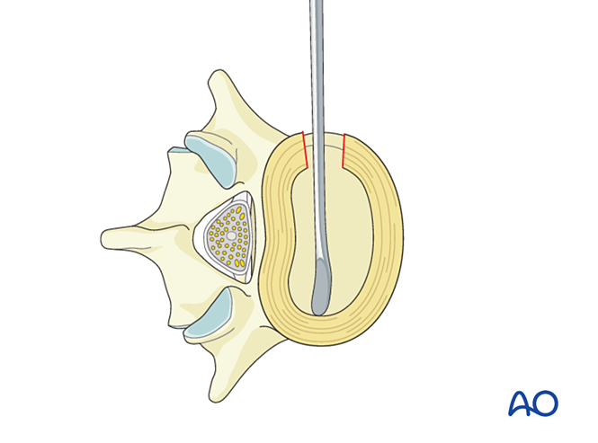 Lateral lumbar interbody fusion (LLIF) for Degenerative spondylolisthesis