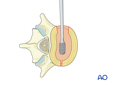 Lateral lumbar interbody fusion (LLIF) for Degenerative spondylolisthesis