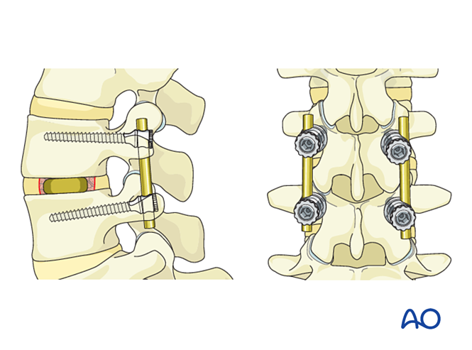 Lateral lumbar interbody fusion (LLIF) for Degenerative spondylolisthesis