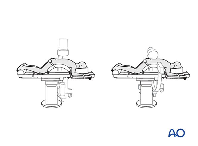 Prone position for approaches to L1–L5