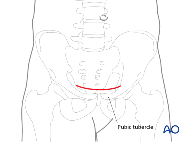 Approach to the pubic symphysis