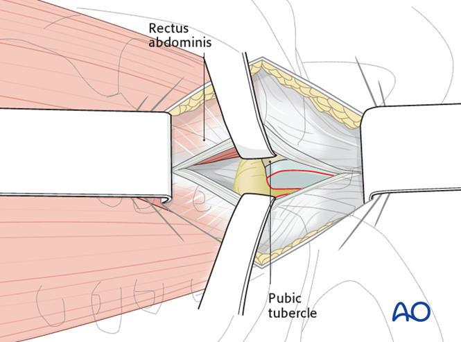 Approach to the pubic symphysis