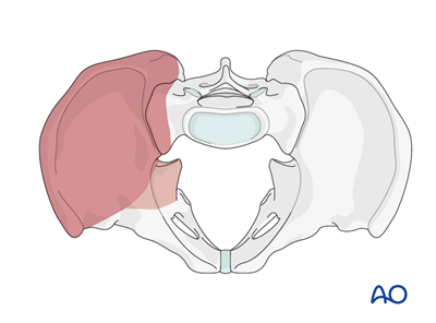 Anterior approach to the iliac wing and SI joint