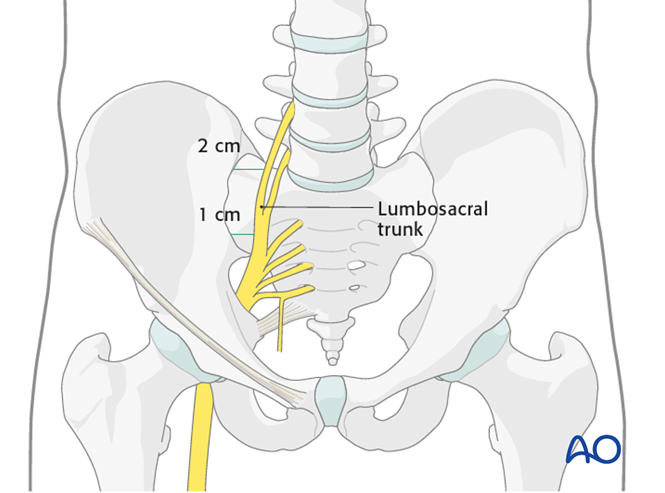 Anterior approach to the iliac wing and SI joint