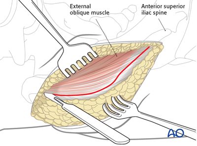 Anterior approach to the iliac wing and SI joint