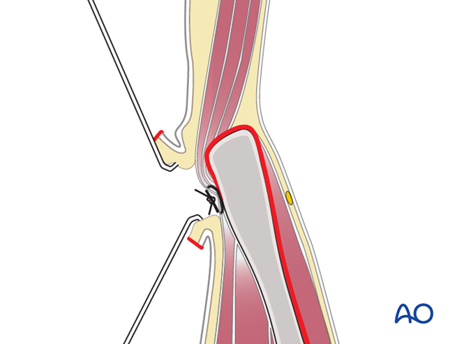 Anterior approach to the iliac wing and SI joint