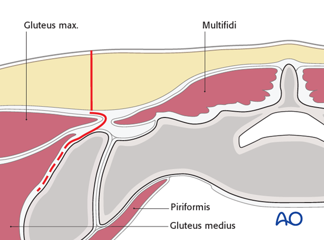 Posterior approach to the SI joint