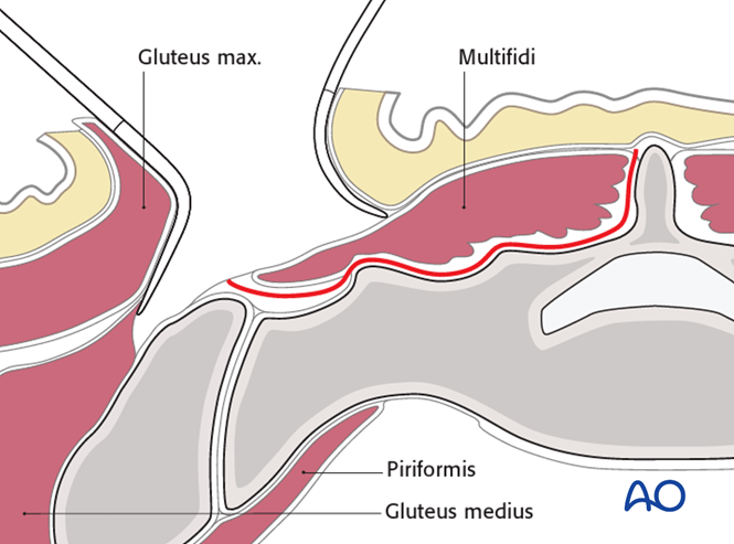 Posterior approach to the SI joint
